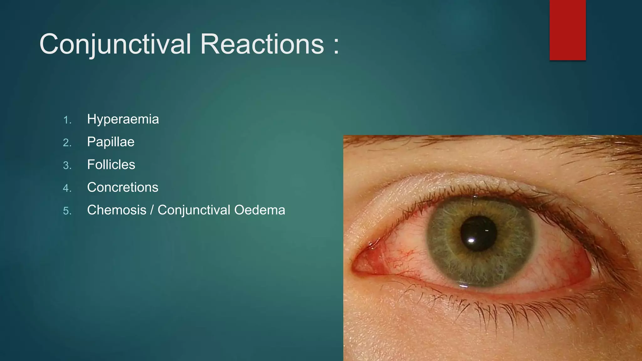 Conjunctiva and its Disorders | PPTX