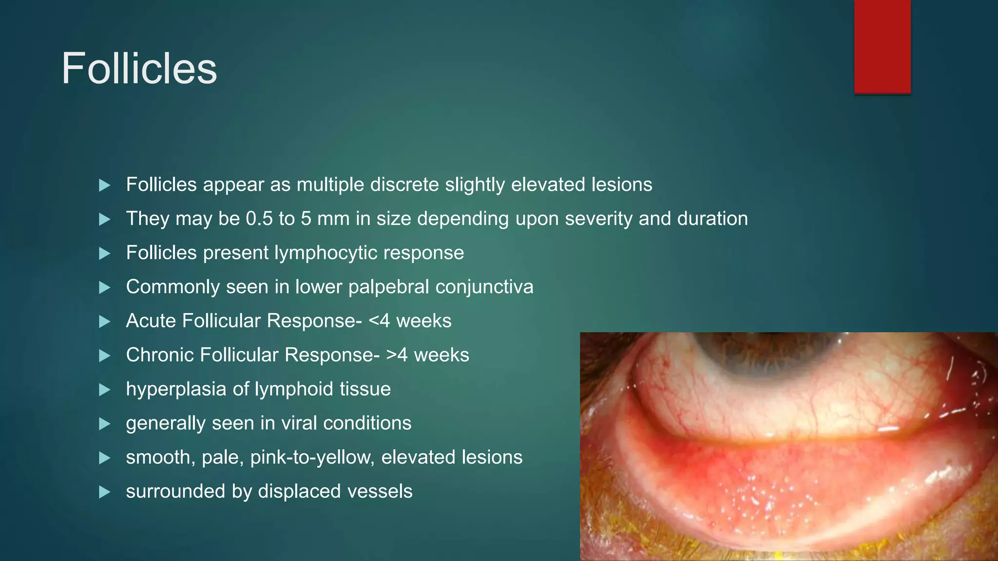 Conjunctiva and its Disorders | PPTX