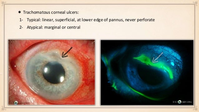 Conjunctiva