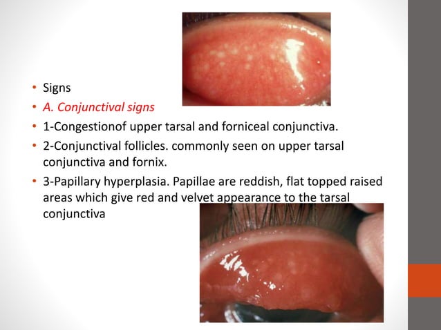Conjunctiva | PPT