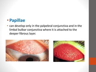 Follicular Vs Papillary Conjunctivitis