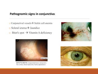 Conjunctiva and sclera | PPTX