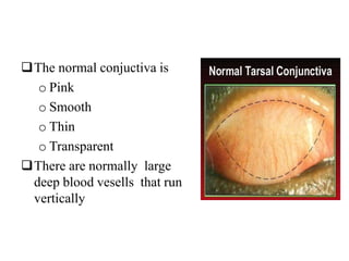 Conjunctival anatomy | PPT