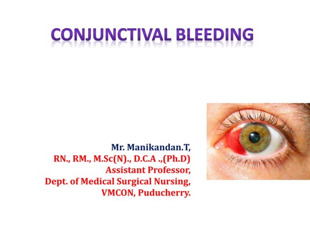 Conjunctival bleeding | PPTX