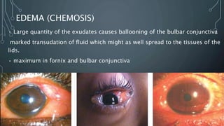 common Conjunctival conditions | PPTX