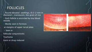 common Conjunctival conditions | PPTX