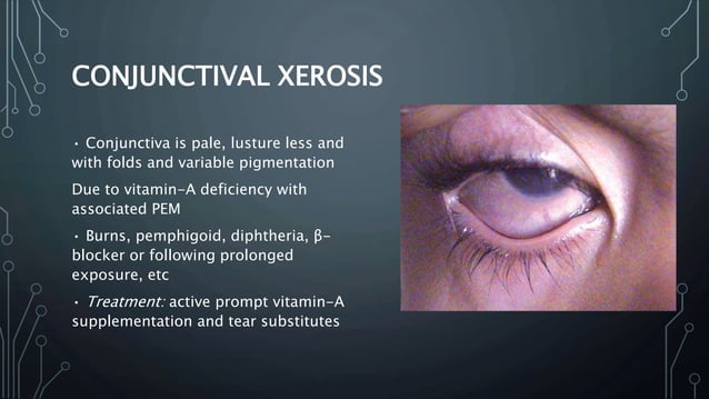 common Conjunctival conditions | PPTX | Blood Disorders | Diseases and ...
