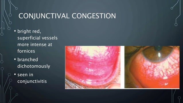common Conjunctival conditions | PPTX | Blood Disorders | Diseases and ...