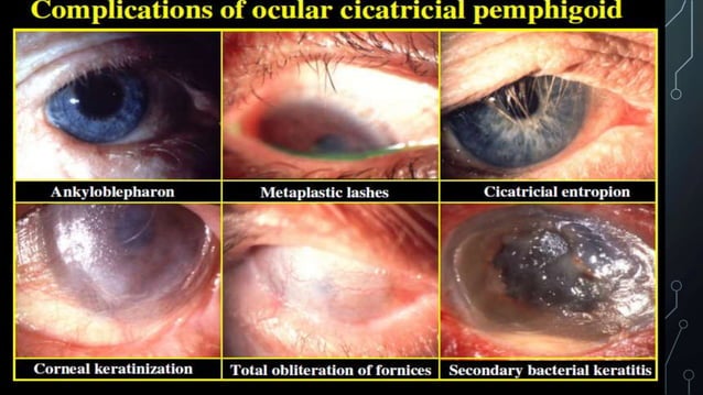 common Conjunctival conditions | PPTX | Blood Disorders | Diseases and ...