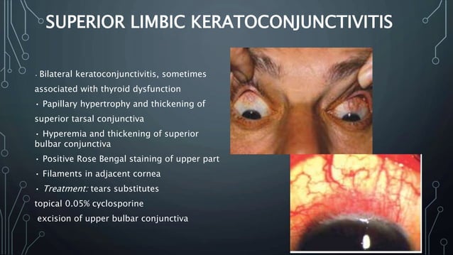 common Conjunctival conditions | PPTX | Blood Disorders | Diseases and ...