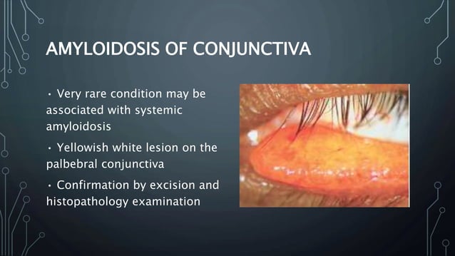 common Conjunctival conditions | PPTX | Blood Disorders | Diseases and ...