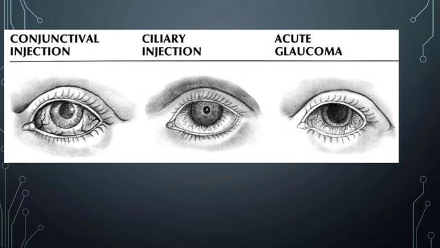 common Conjunctival conditions | PPTX | Blood Disorders | Diseases and ...