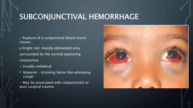 common Conjunctival conditions | PPTX | Blood Disorders | Diseases and ...