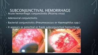 common Conjunctival conditions | PPTX