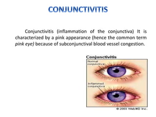 Conjunctival disorder | PPTX