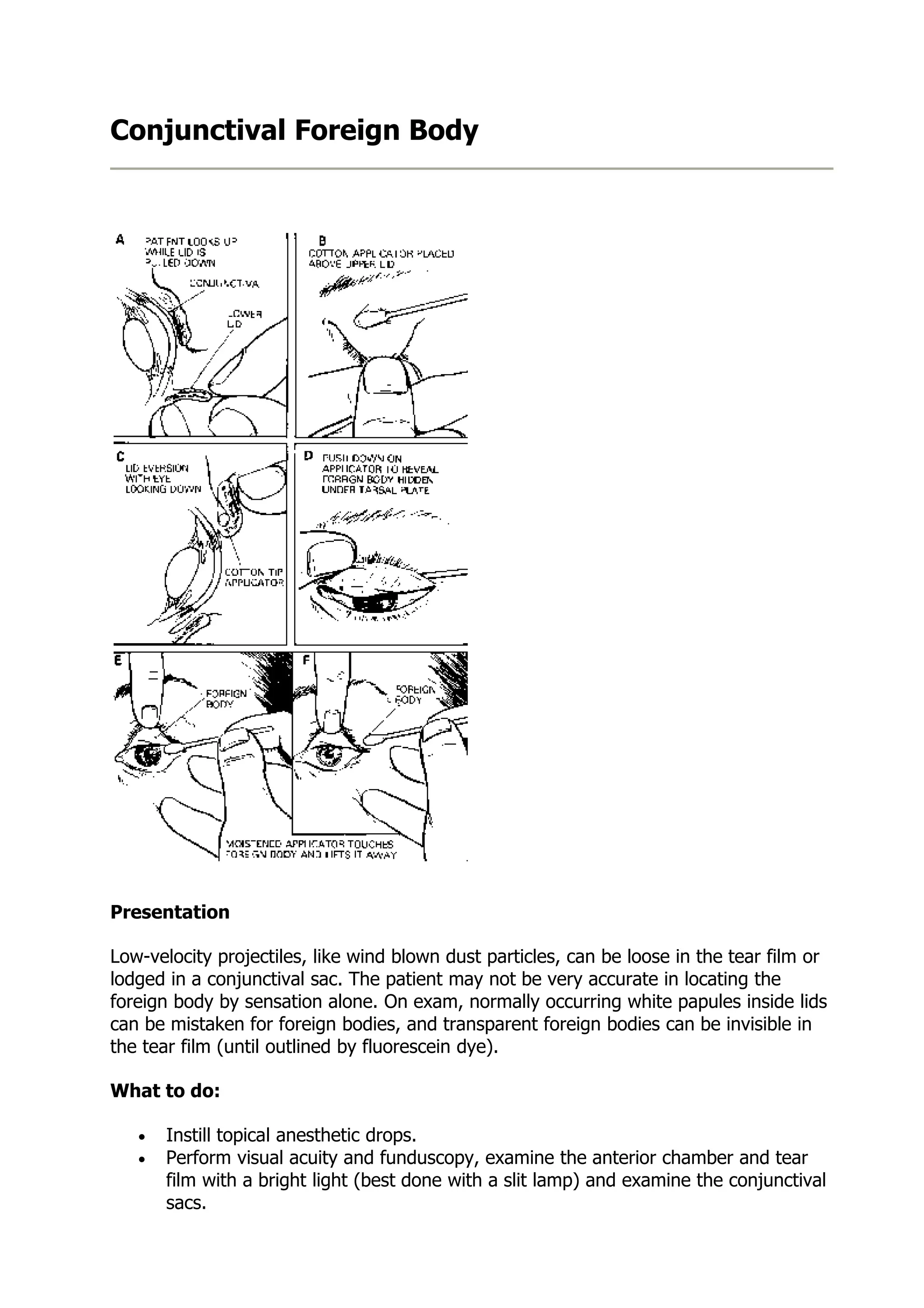 Conjunctival Foreign Body | DOC
