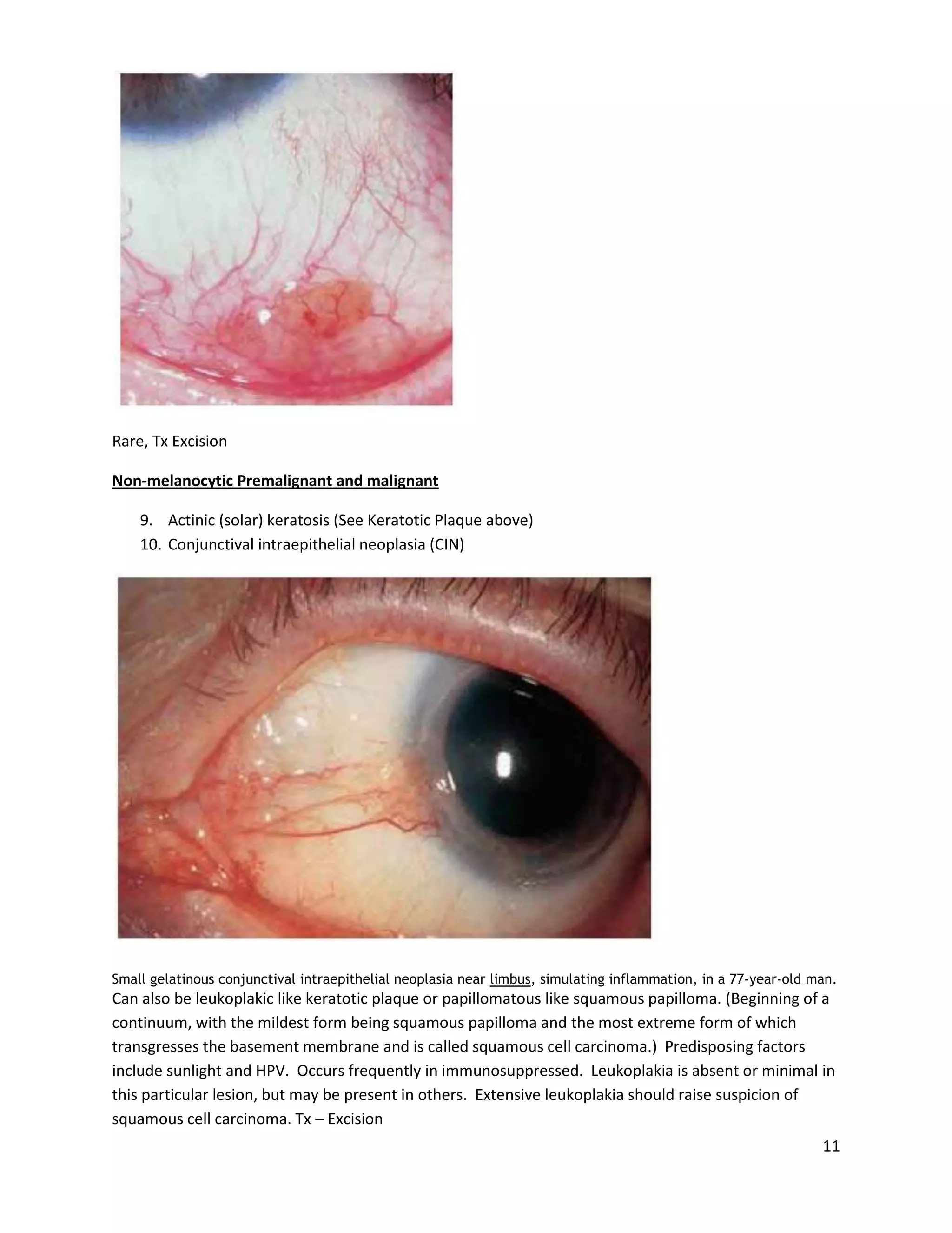 Conjunctival tumors | DOCX