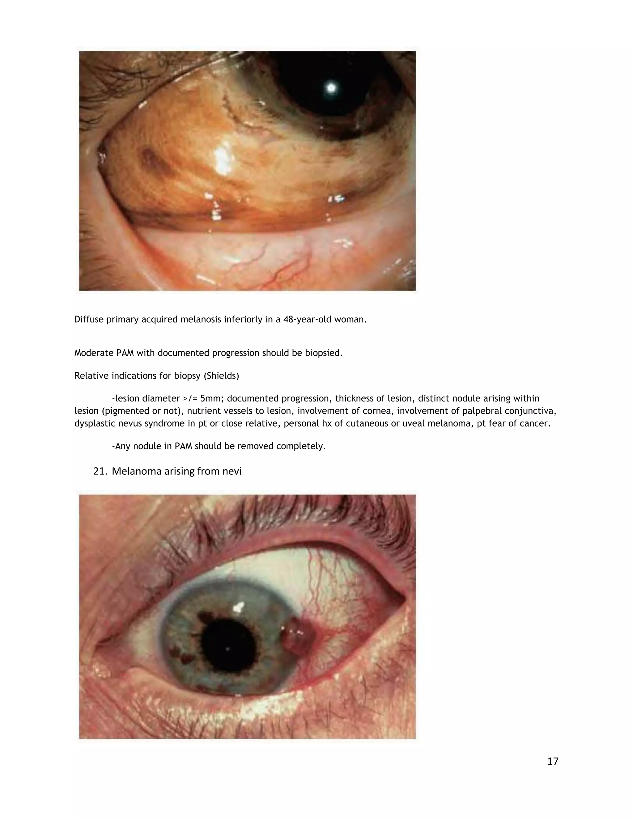 Conjunctival tumors | DOCX