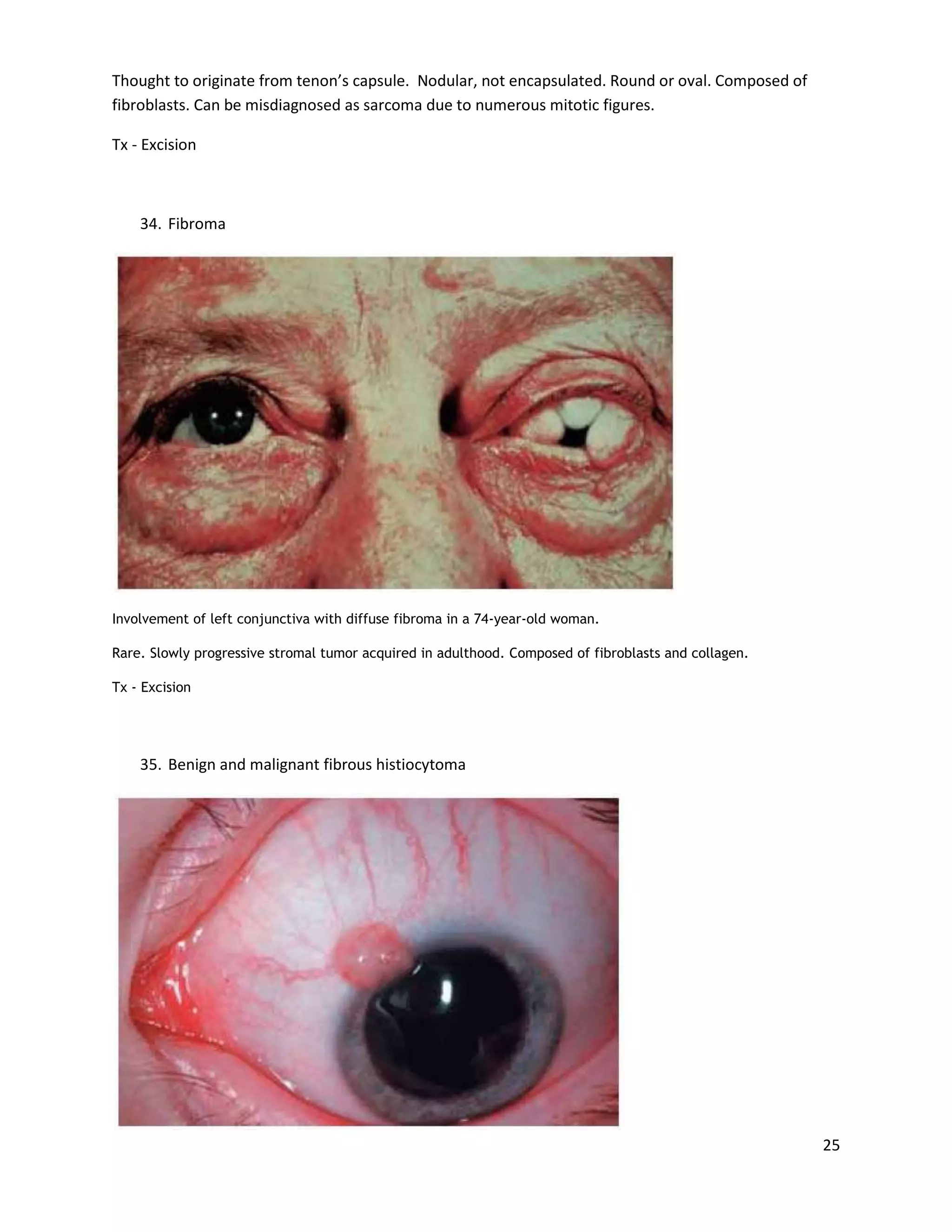 Conjunctival tumors | DOCX
