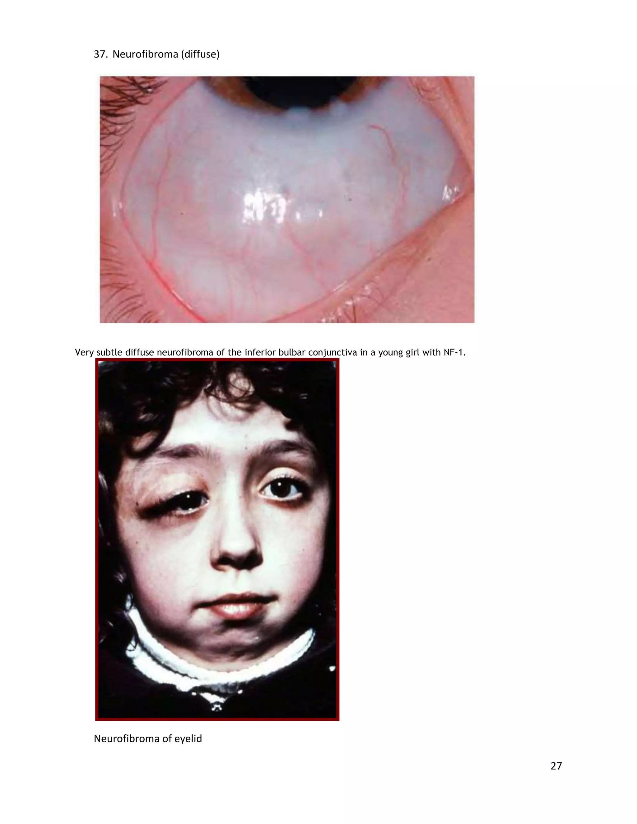 Conjunctival tumors | DOCX