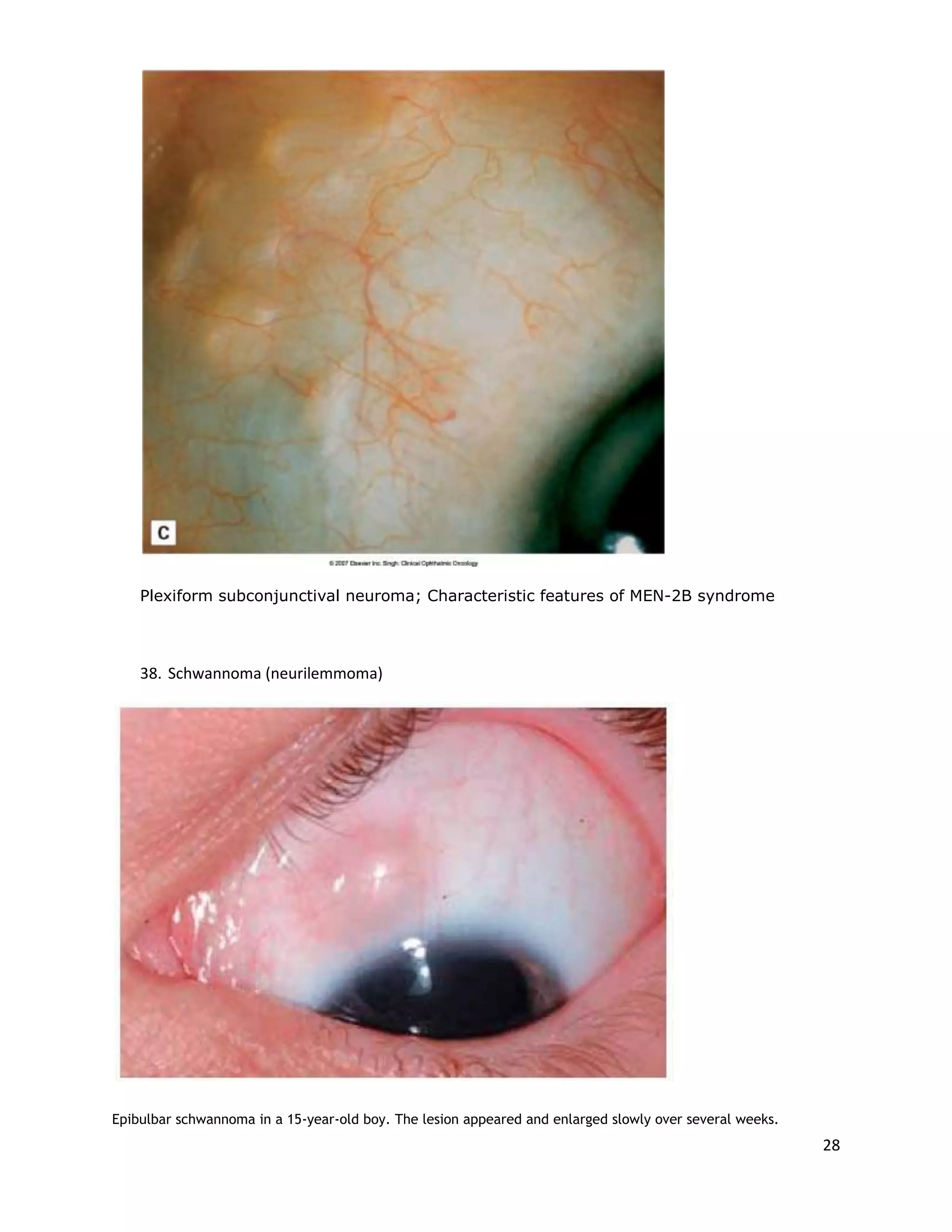 Conjunctival tumors | DOCX