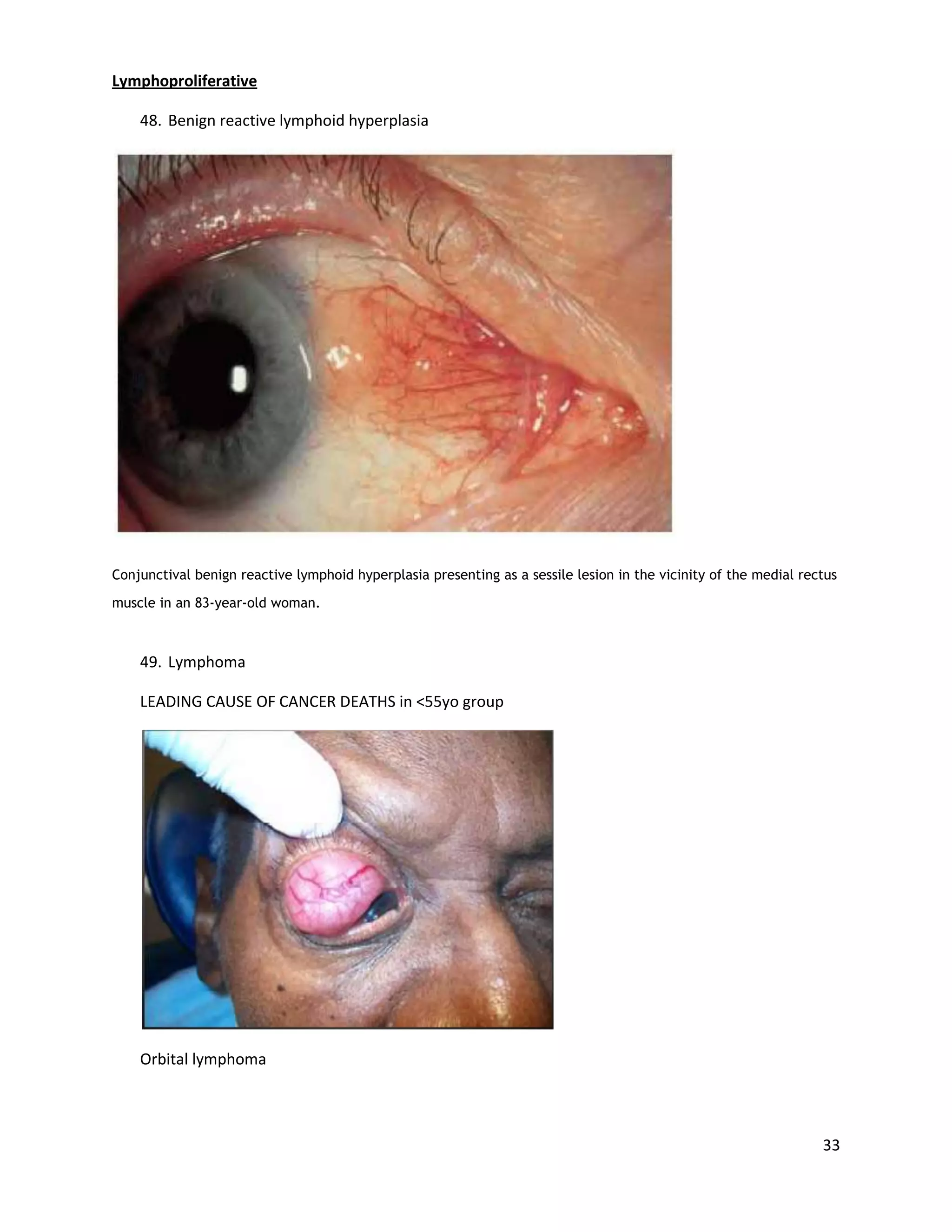 Conjunctival tumors | DOCX