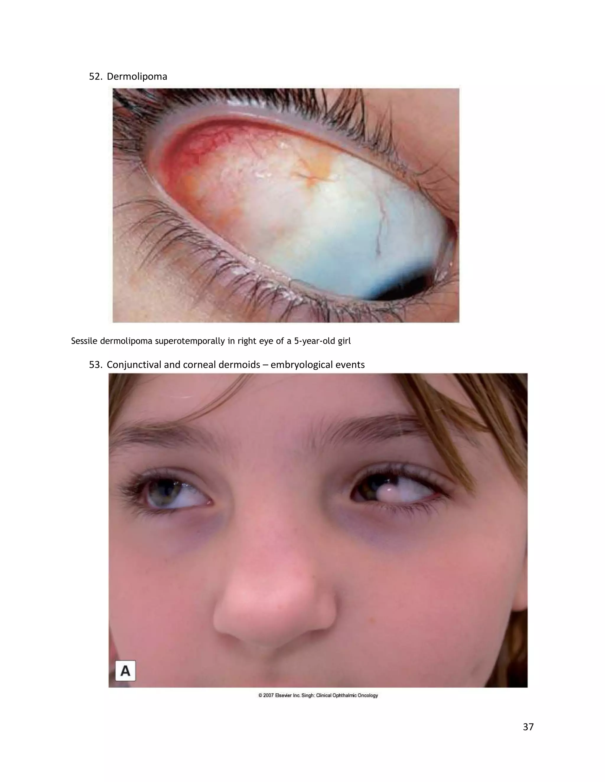 Conjunctival tumors | DOCX