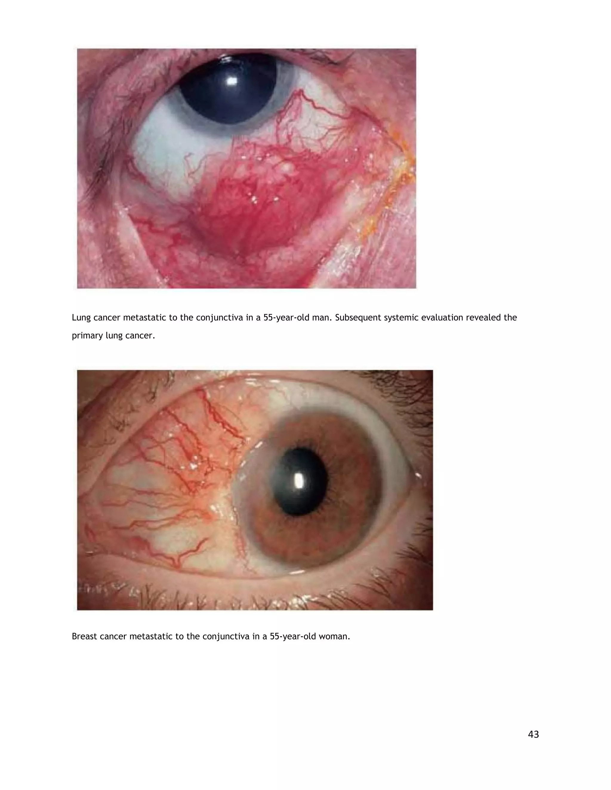 Conjunctival tumors | DOCX