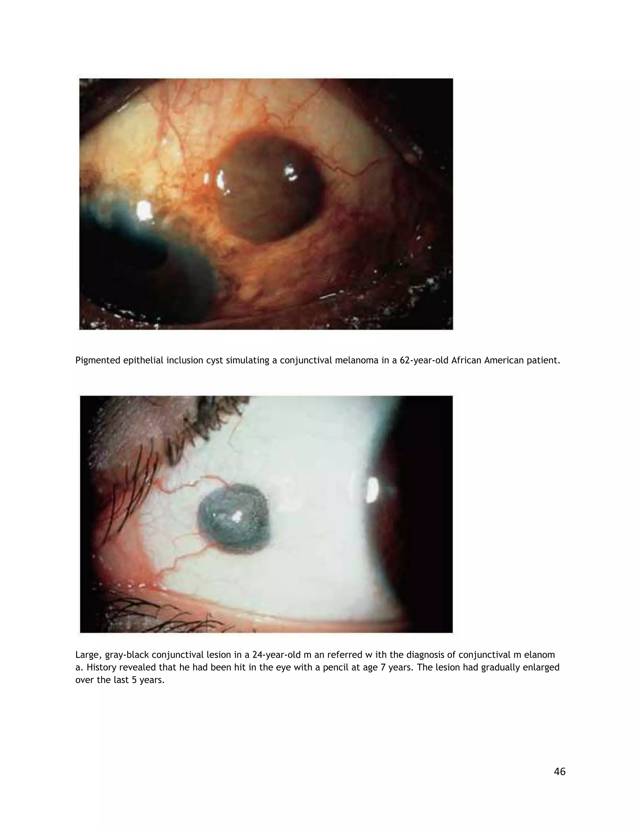 Conjunctival tumors | DOCX