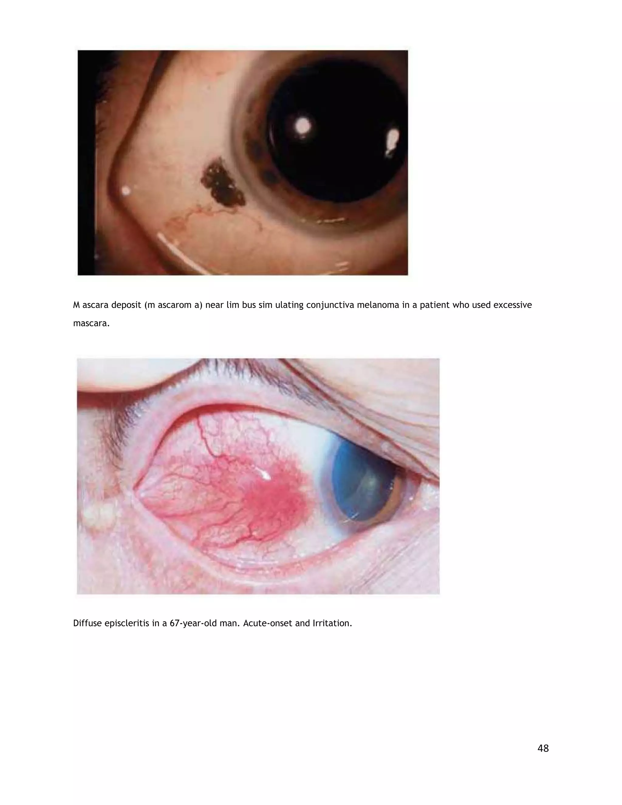 Conjunctival tumors | DOCX