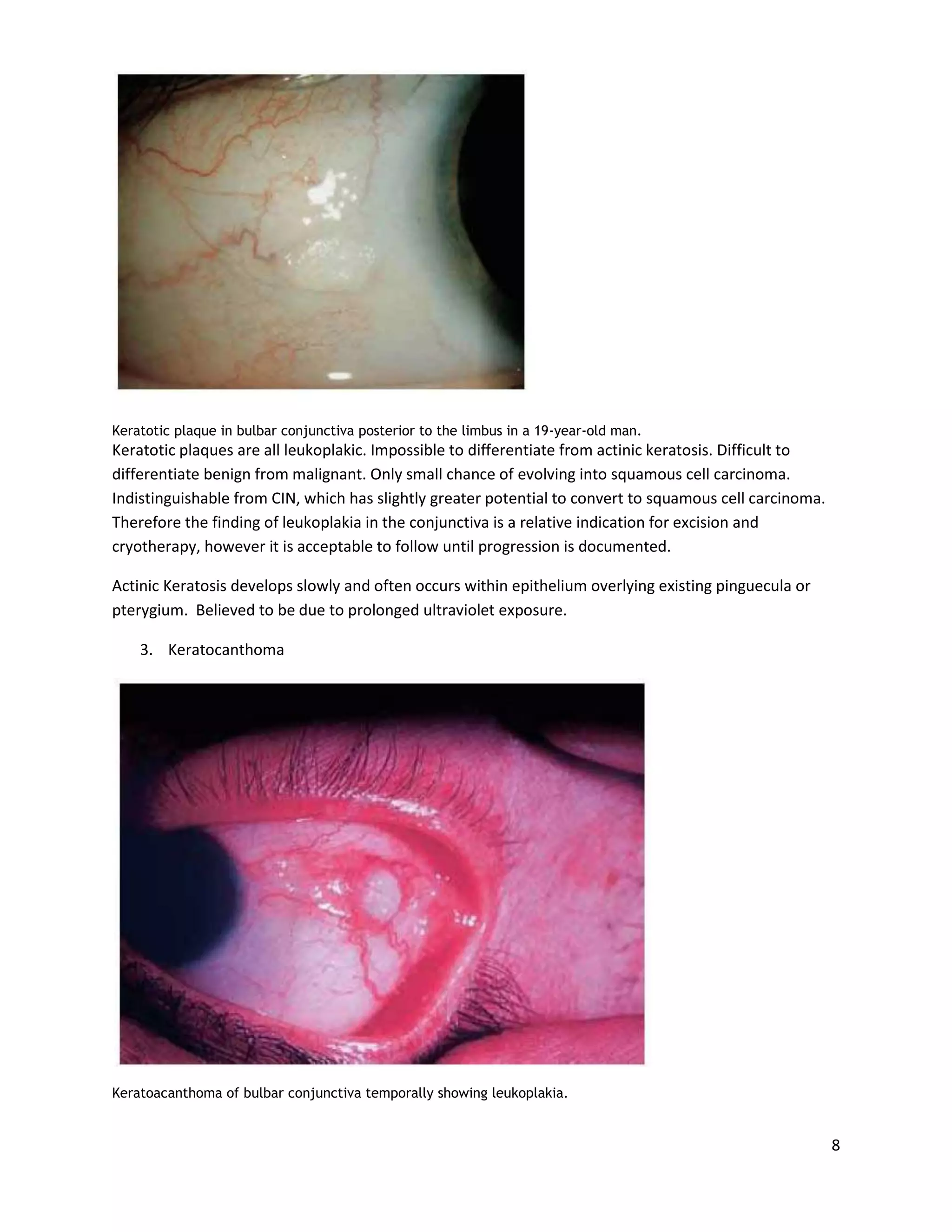 Conjunctival tumors | DOCX