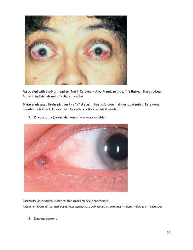 Conjunctival tumors | DOCX