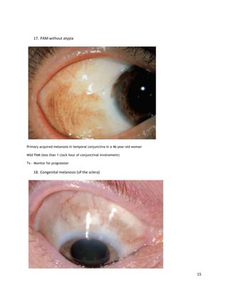 Primary Acquired Melanosis