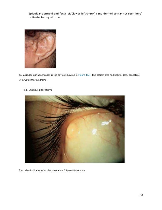Conjunctival tumors