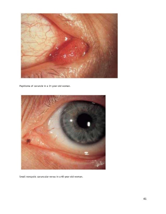 Conjunctival tumors