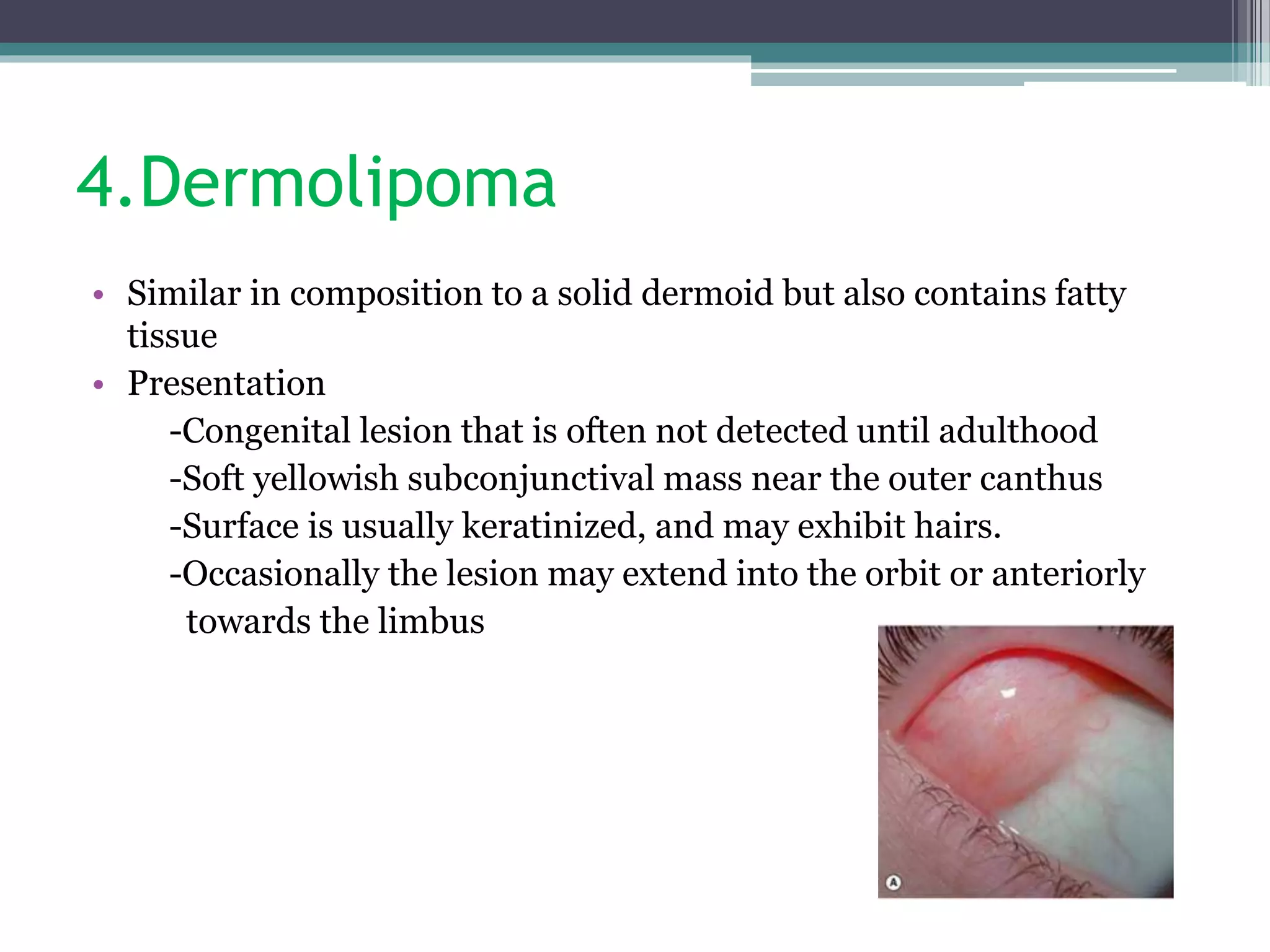 Conjunctival tumors | PPTX