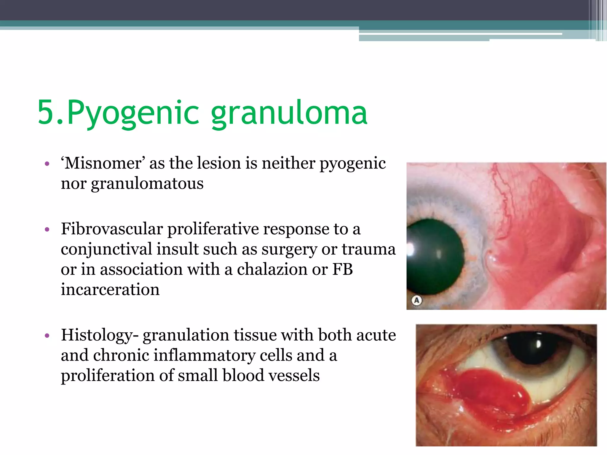 Conjunctival tumors | PPTX