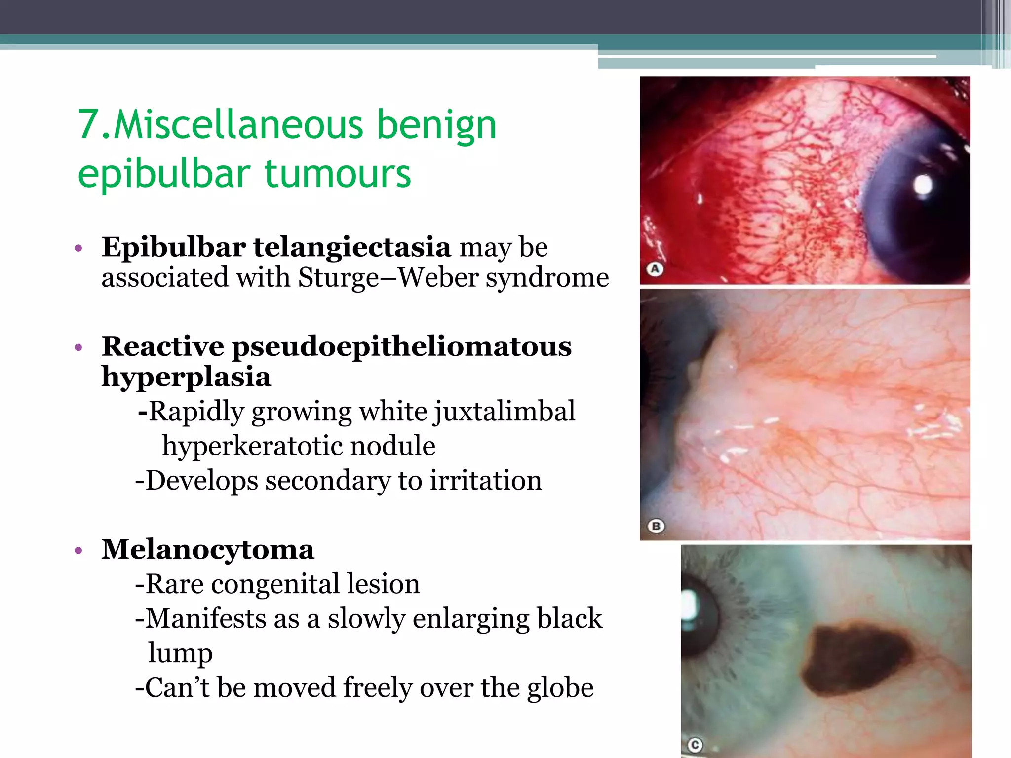 Conjunctival tumors | PPTX