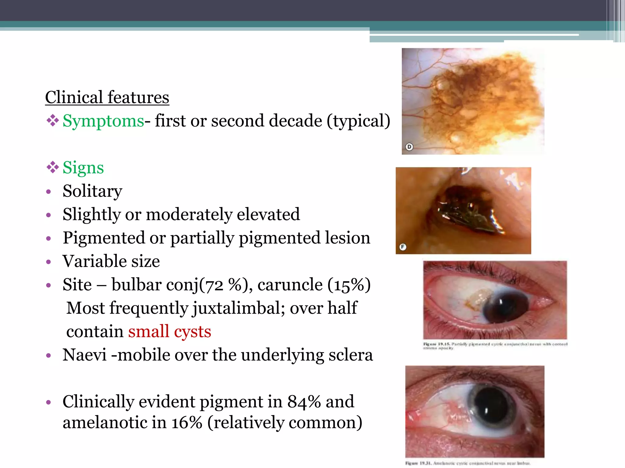 Conjunctival tumors | PPTX