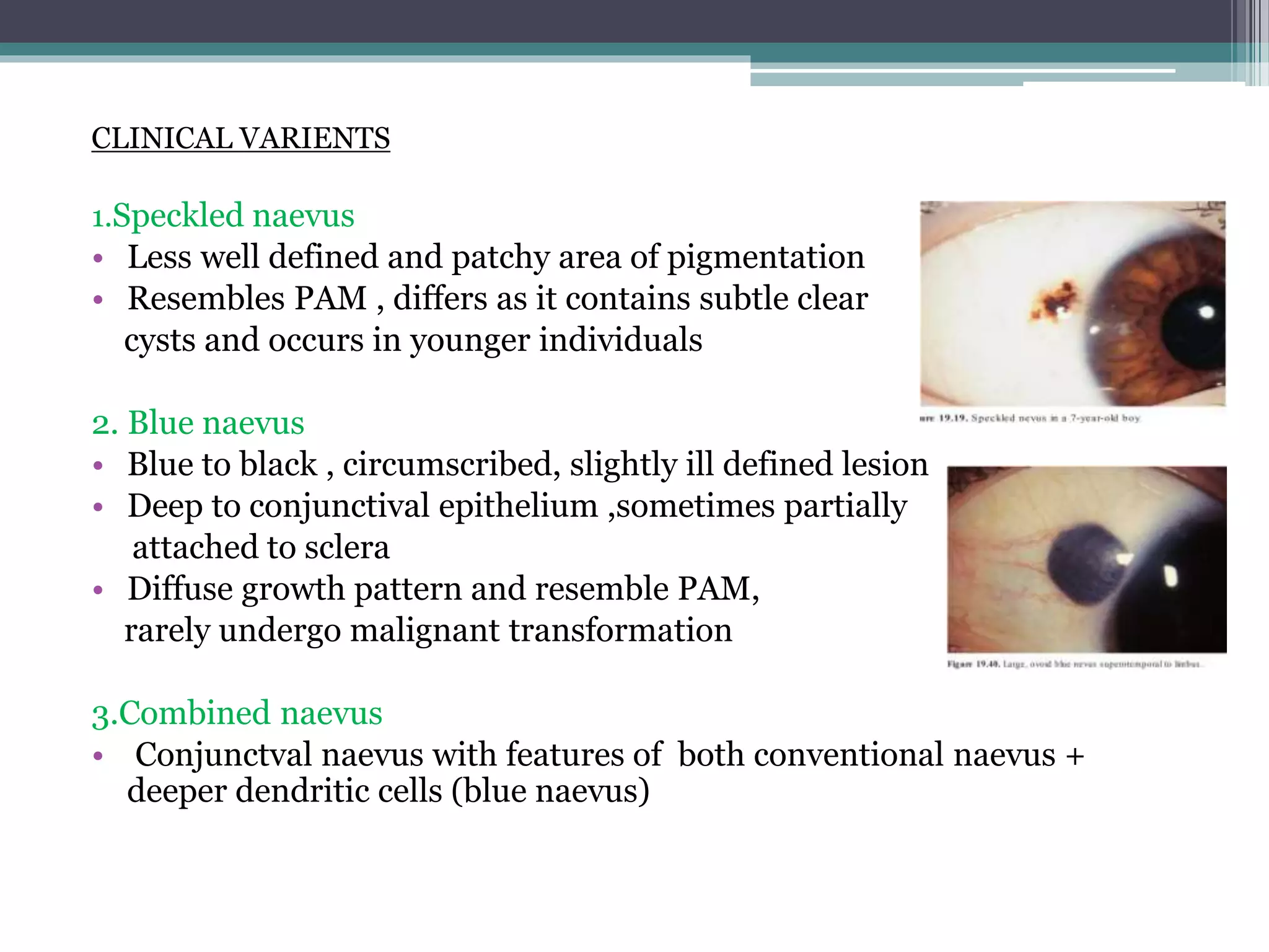Conjunctival tumors | PPTX