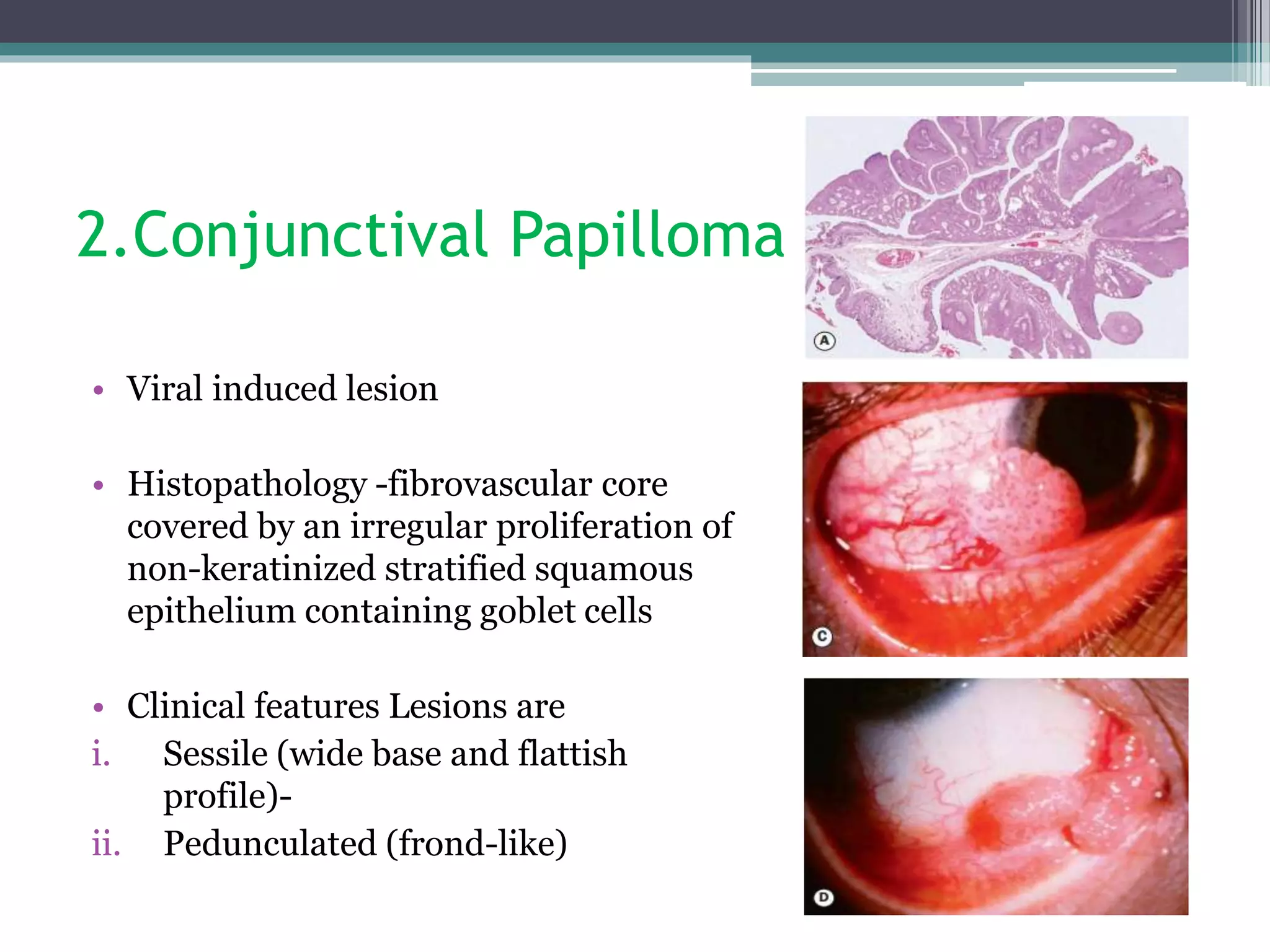 Conjunctival tumors | PPTX