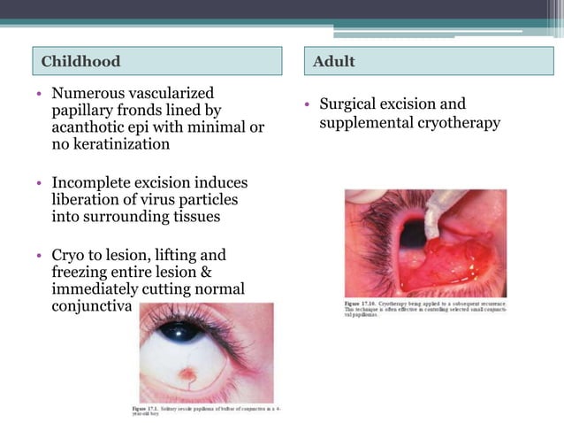 Conjunctival tumors | PPTX | Eye and Vision Conditions | Diseases and ...