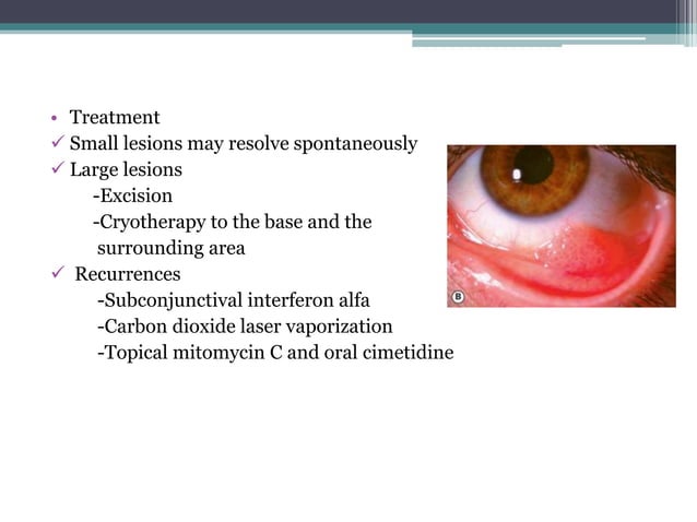 Conjunctival tumors | PPTX | Eye and Vision Conditions | Diseases and ...