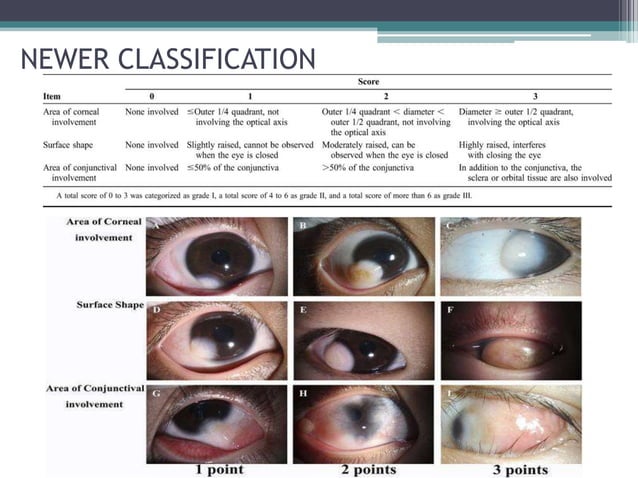 Conjunctival tumors | PPTX | Eye and Vision Conditions | Diseases and ...