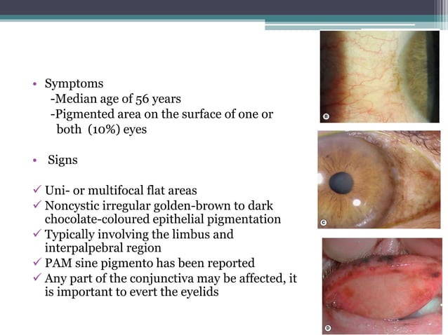 Conjunctival tumors | PPTX | Eye and Vision Conditions | Diseases and ...