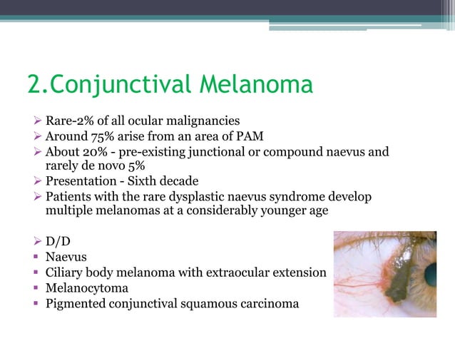 Conjunctival tumors | PPTX | Eye and Vision Conditions | Diseases and ...