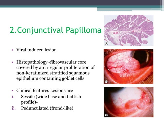 Conjunctival tumors | PPTX | Eye and Vision Conditions | Diseases and ...