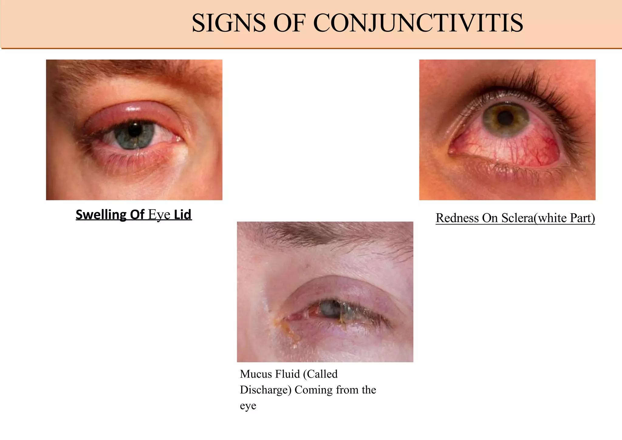 Conjunctivatis presentation.AJ.pptx