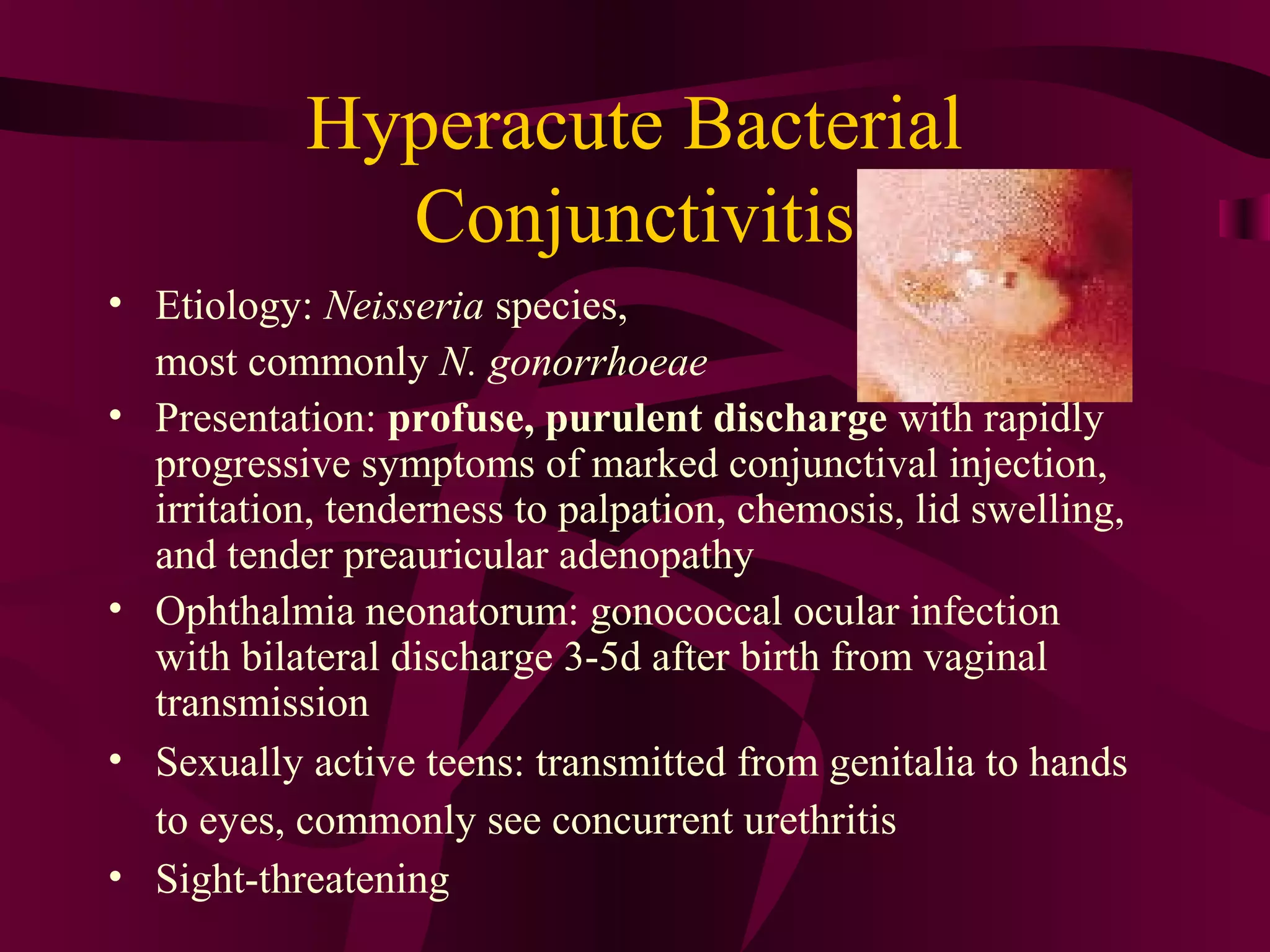 Conjunctivitis | PPT