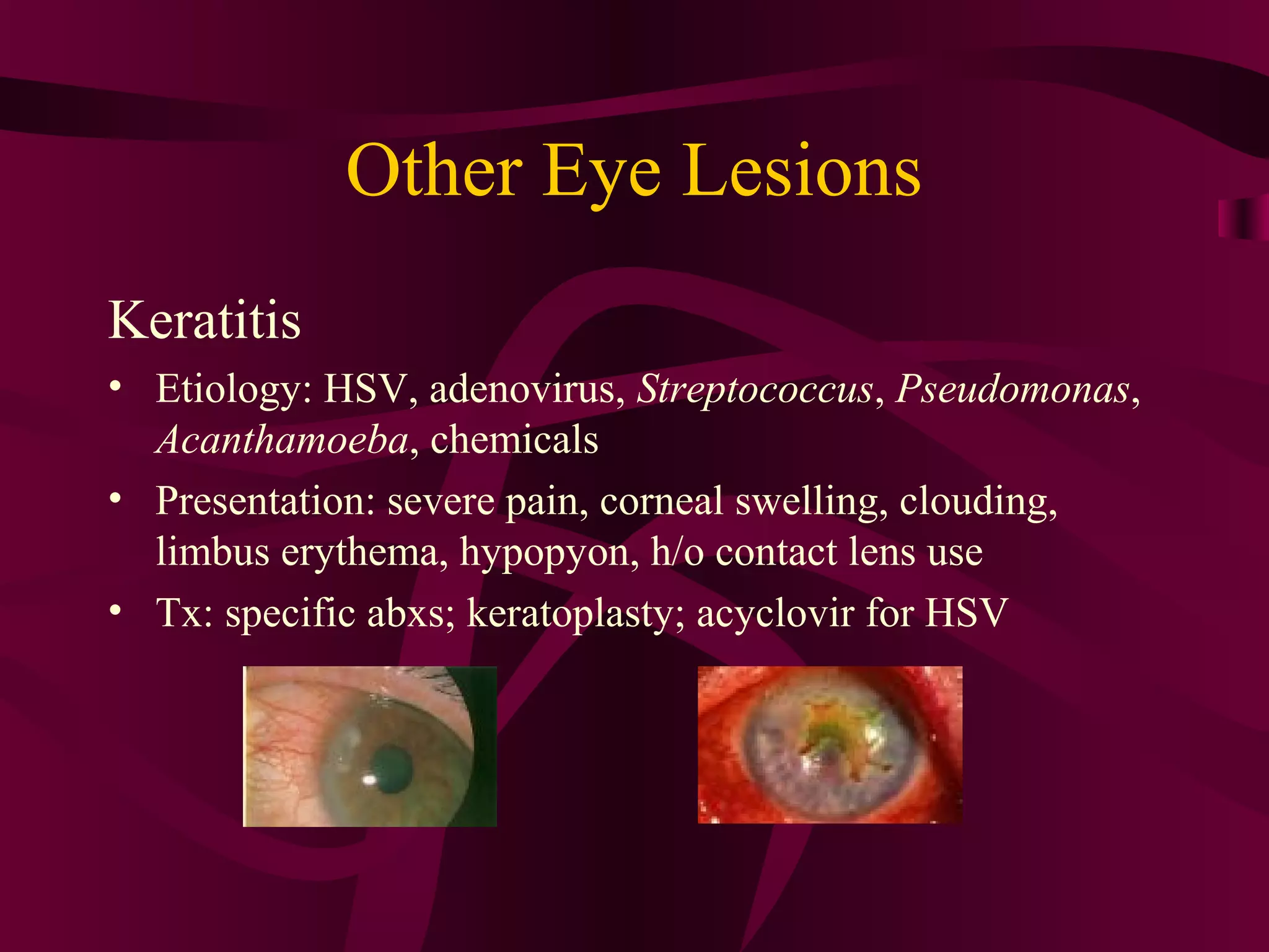Conjunctivitis | PPT